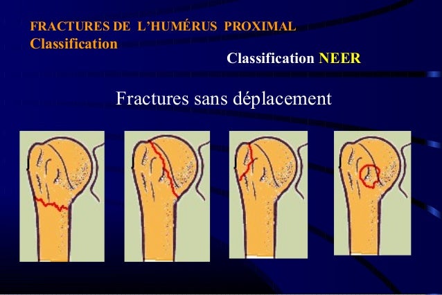 6.fracturi mb sup fr