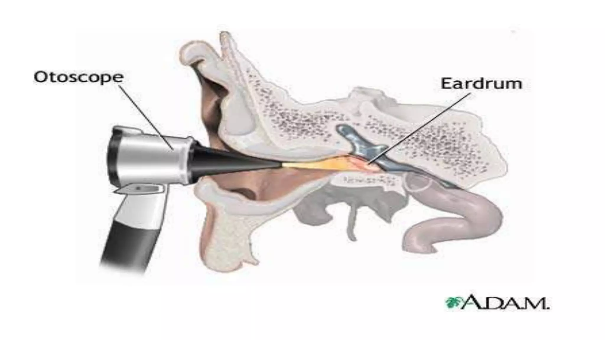 6. otitis externa | PPTX