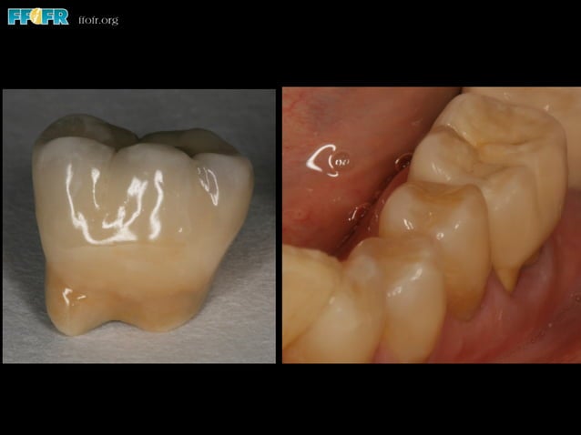 6. secondary imp materials | PDF | Dental Health | Diseases and Conditions