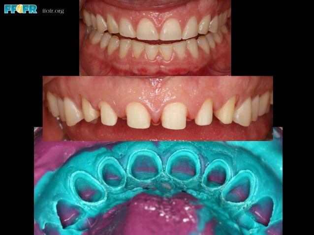 6. secondary imp materials | PDF | Dental Health | Diseases and Conditions