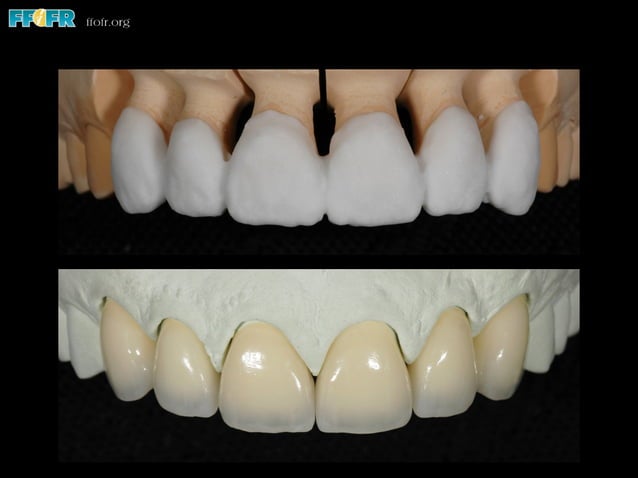 6. secondary imp materials | PDF | Dental Health | Diseases and Conditions