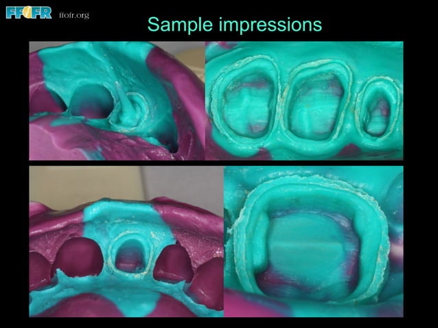6. secondary imp materials | PDF | Dental Health | Diseases and Conditions