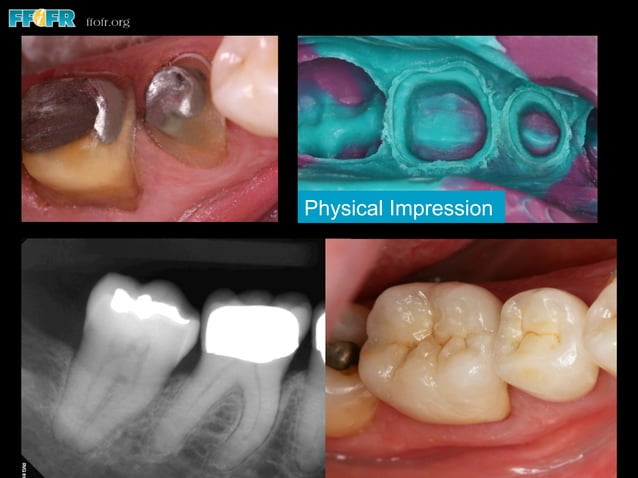 6. secondary imp materials | PDF | Dental Health | Diseases and Conditions