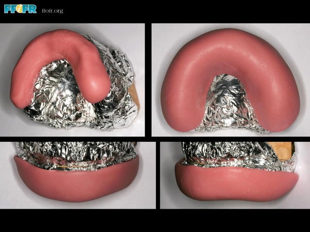 6. secondary imp materials | PDF | Dental Health | Diseases and Conditions