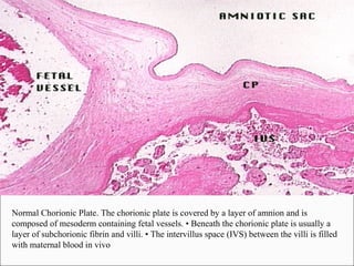 Placenta Chorionic Plate Of