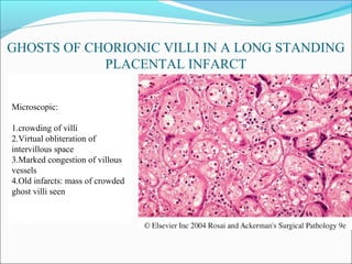 Chorionic Villi Histology