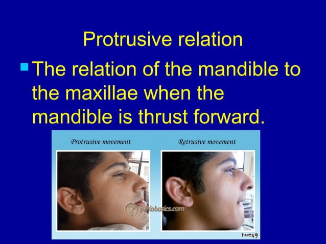 maxillomandibular relations - terminology | PPT | Dental Health ...