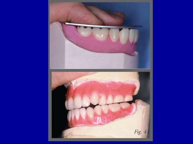 maxillomandibular relations - terminology | PPT | Dental Health ...