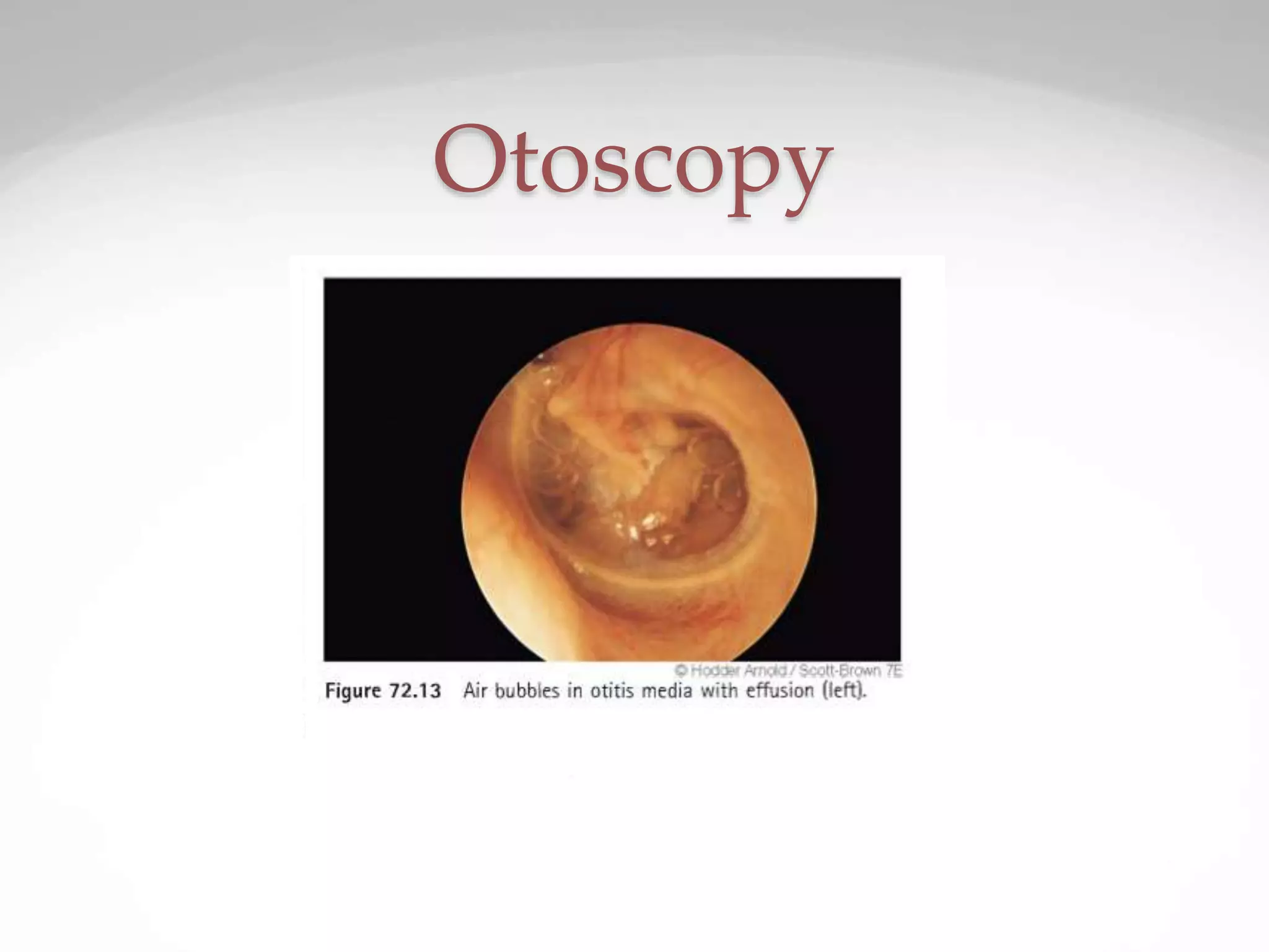 OME-Otitis Media with effusion in children | PPTX