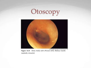 OME-Otitis Media with effusion in children | PPTX