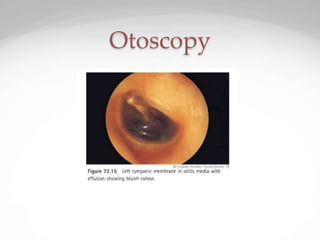 OME-Otitis Media with effusion in children | PPTX