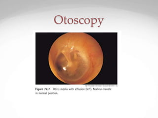 Otitis Media With Effusion Otoscope