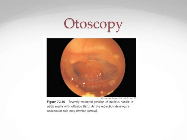 OME-Otitis Media with effusion in children