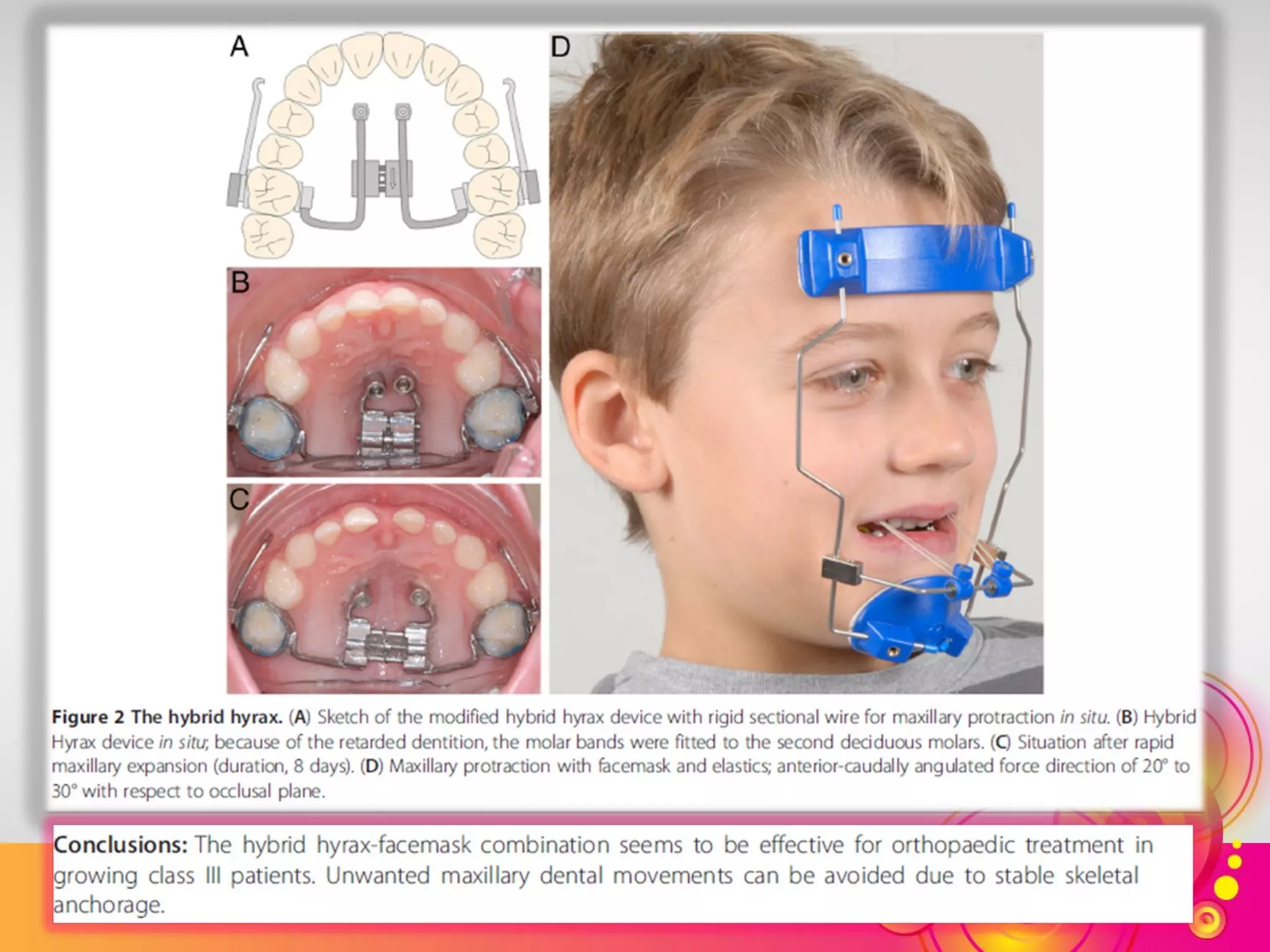 hygenic rapid maxillary expansion in orthodontics | PPT
