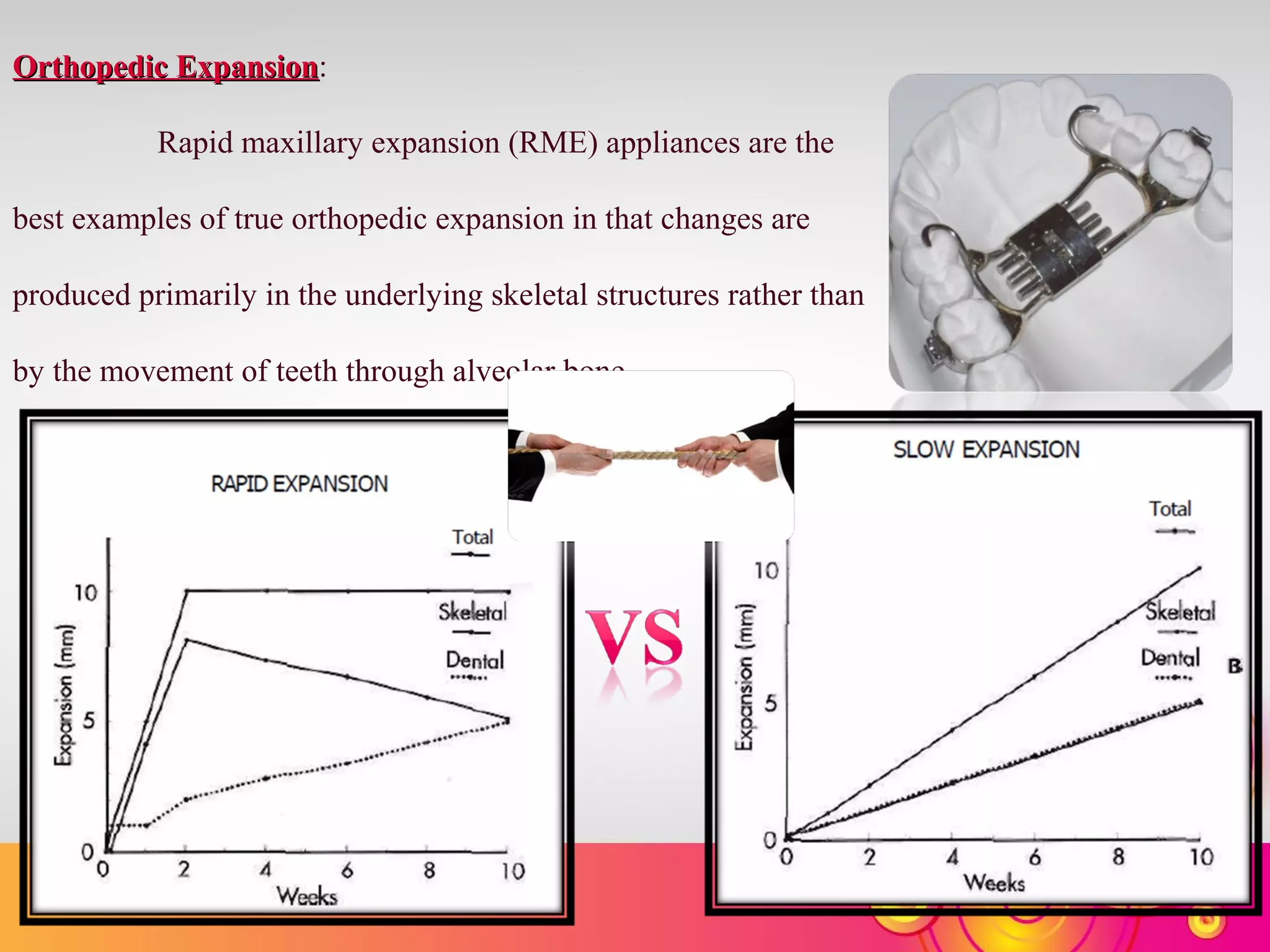 hygenic rapid maxillary expansion in orthodontics | PPT
