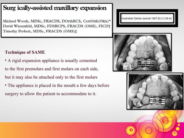 hygenic rapid maxillary expansion in orthodontics | PPT