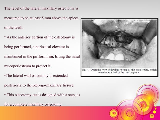 hygenic rapid maxillary expansion in orthodontics | PPT