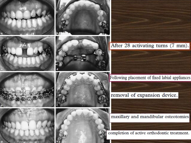 hygenic rapid maxillary expansion in orthodontics | PPT