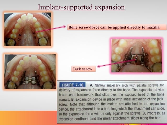 hygenic rapid maxillary expansion in orthodontics | PPT