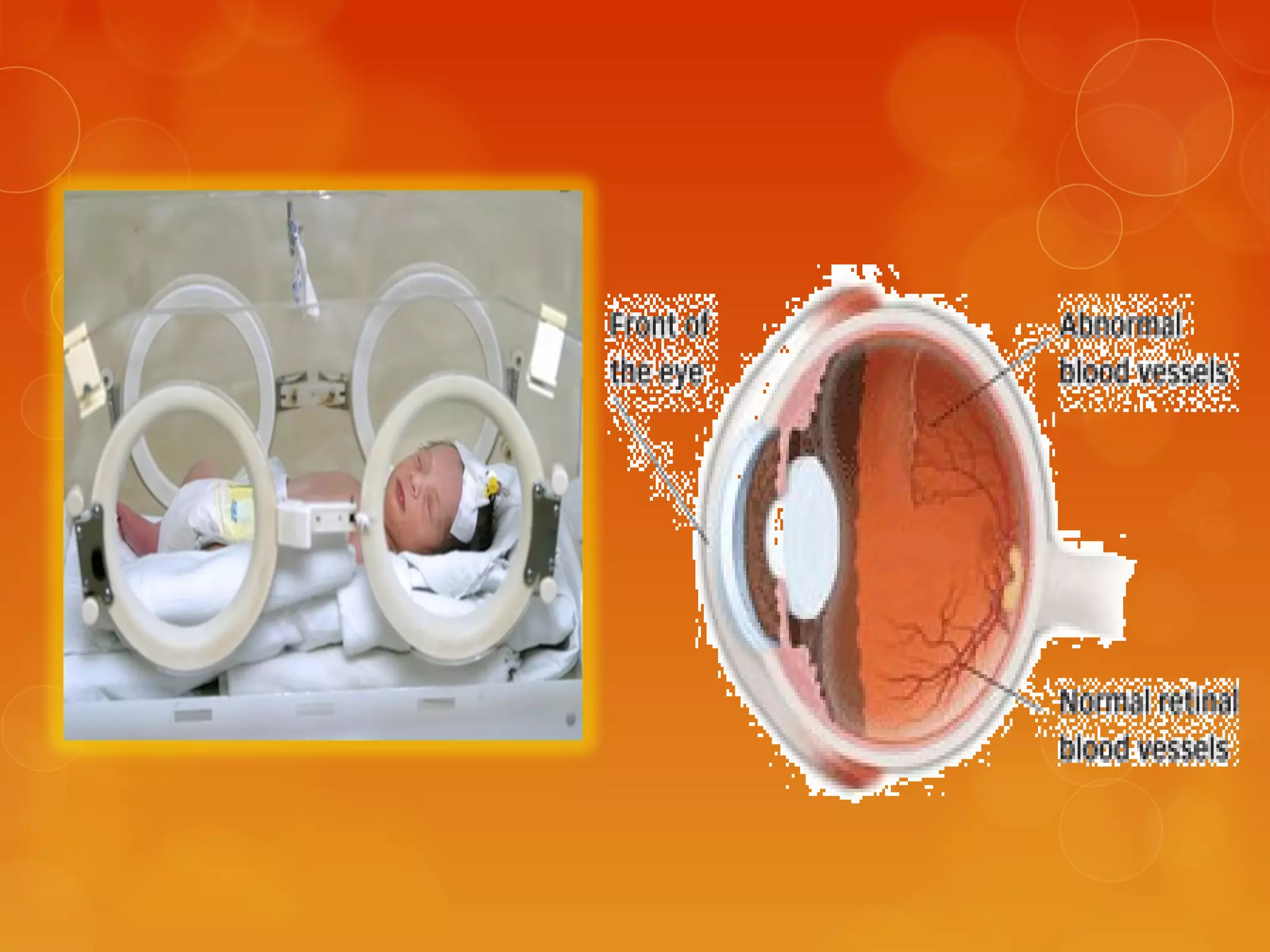 RETINOPATHY OF PREMATURITY | PPT