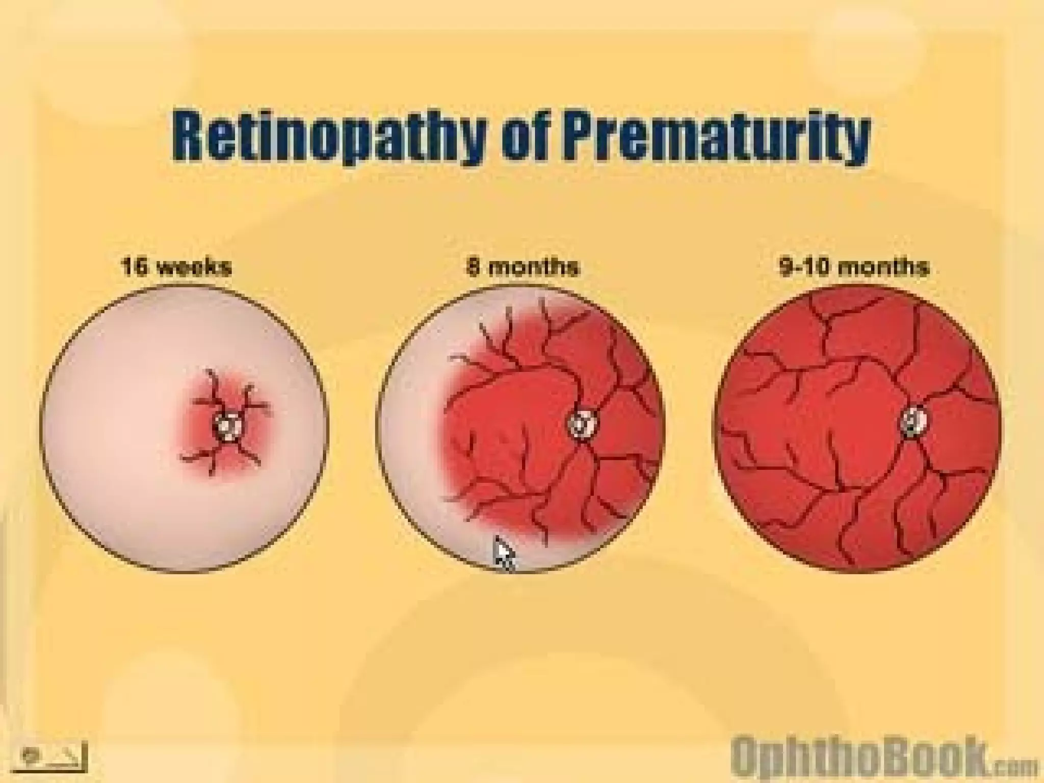 RETINOPATHY OF PREMATURITY | PPT