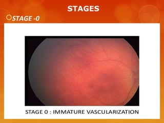 RETINOPATHY OF PREMATURITY | PPT