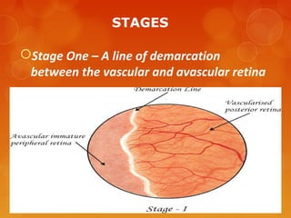 RETINOPATHY OF PREMATURITY | PPT