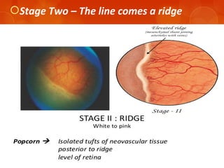 RETINOPATHY OF PREMATURITY | PPT