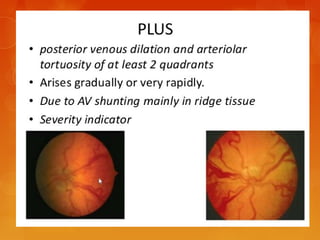 Retinopathy Of Prematurity Plus Disease