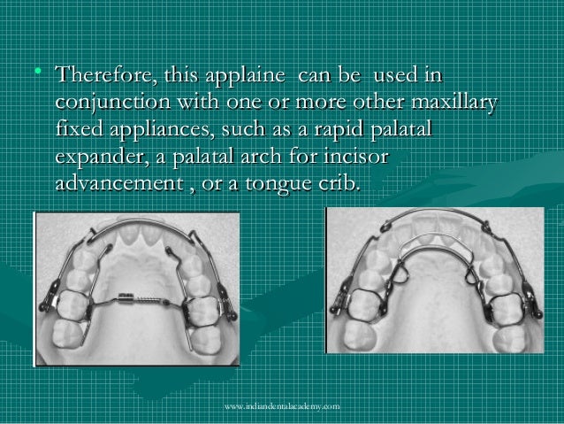 a fixed reverse labial bow for moderate class iii interceptive treatm…