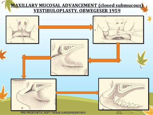 6.pre prosthetic surgery(54) Dr. RAHUL TIWARI