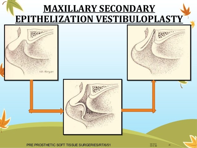 6.pre prosthetic surgery(54) Dr. RAHUL TIWARI