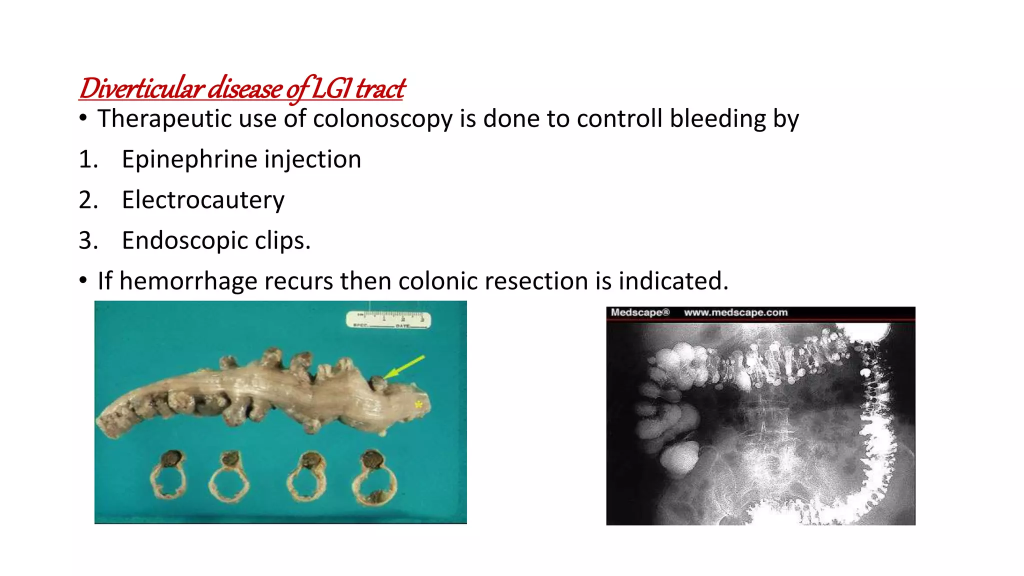 LOWER GI BLEEDING | PPTX