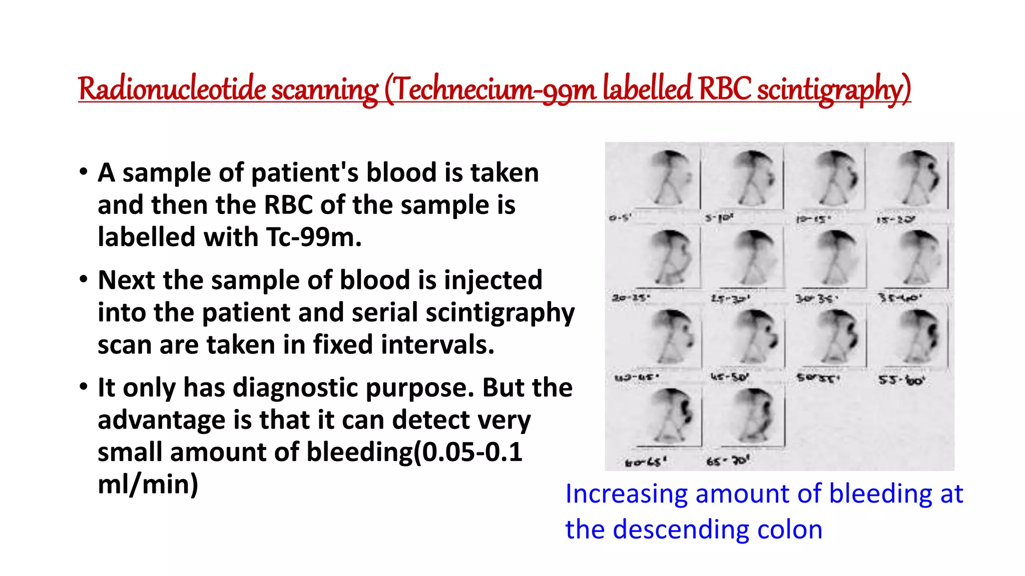 LOWER GI BLEEDING | PPTX