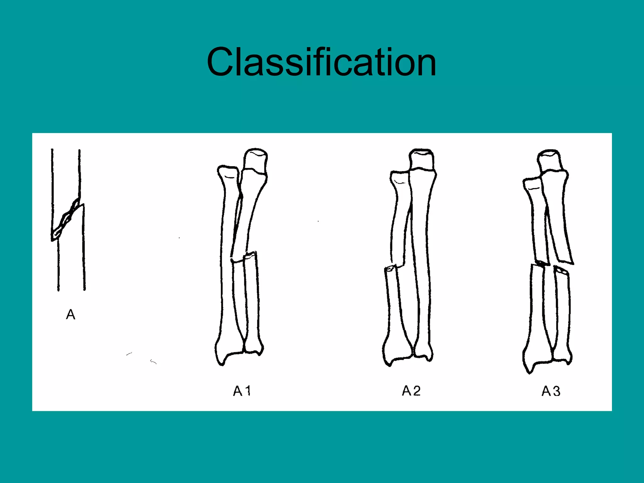 Fracture of Forearm Bones | PPT