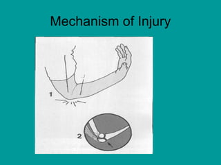 Fracture of Forearm Bones | PPT