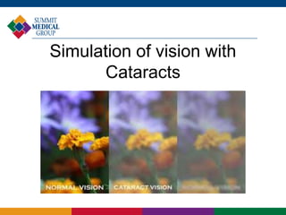Cataract Vision Simulation