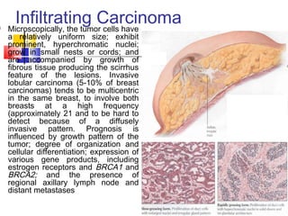 Breast cancer. TNM as a logical model in Cancer Diagnosis | PPT