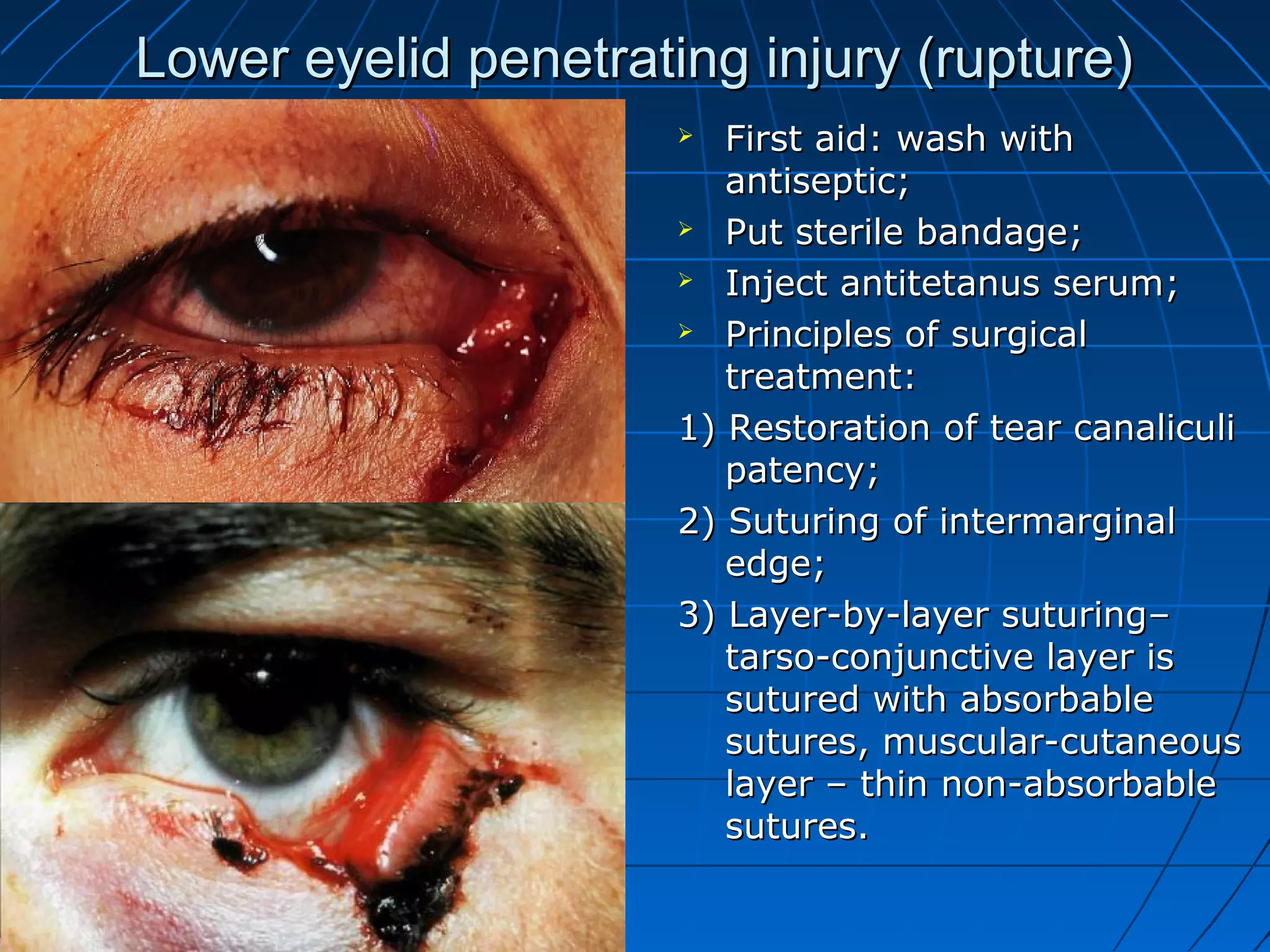 Ocular Traumatic Damages | PPT