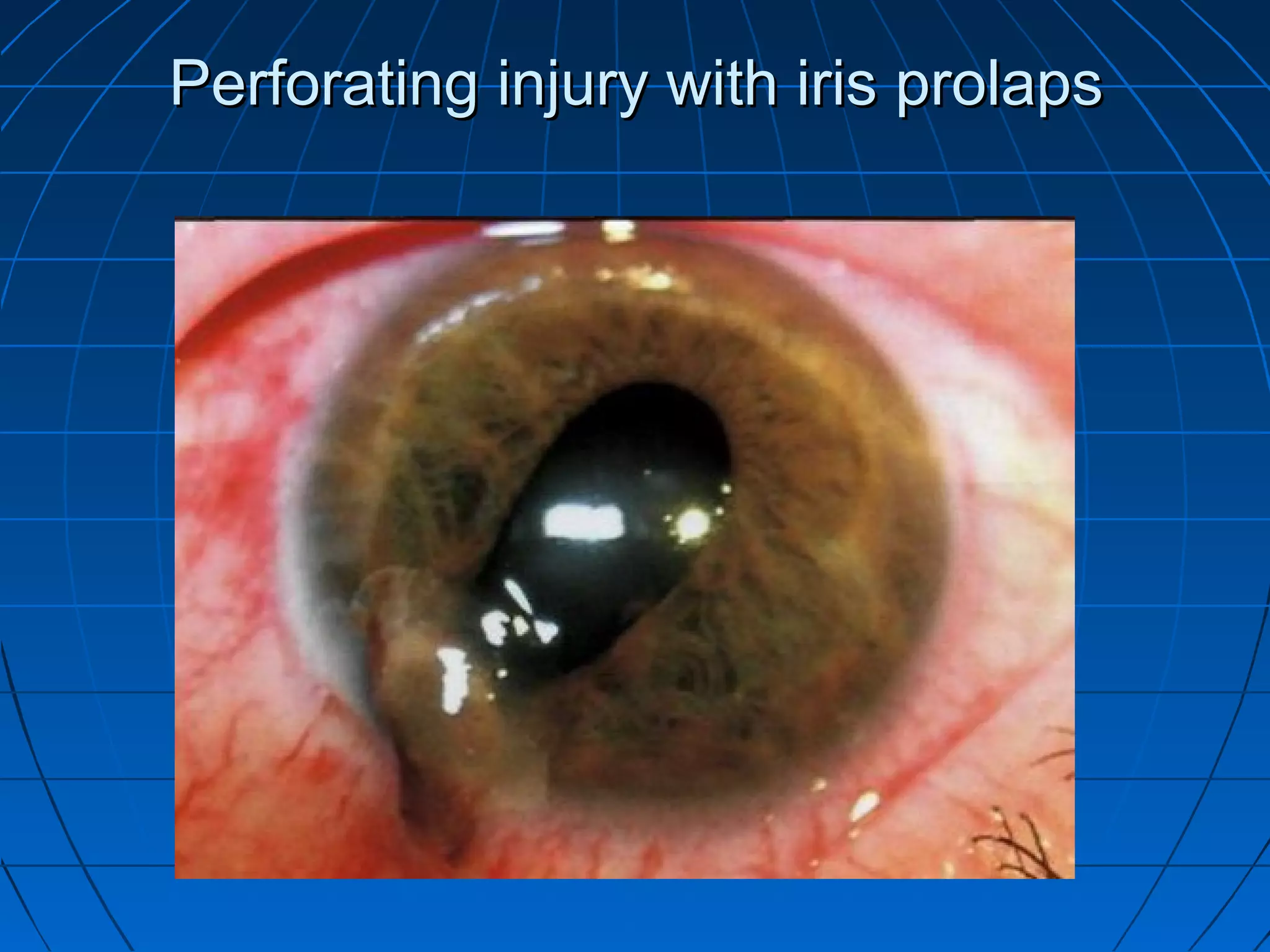 Ocular Traumatic Damages | PPT