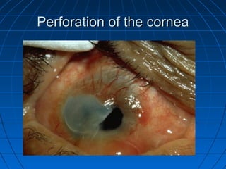 Ocular Traumatic Damages | PPT