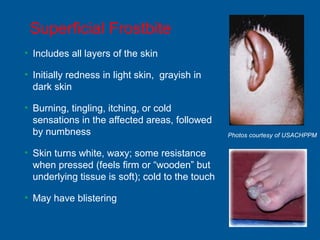 Cold Related Injuries. Hypothermia, Frostbite & Trench foot | PPT