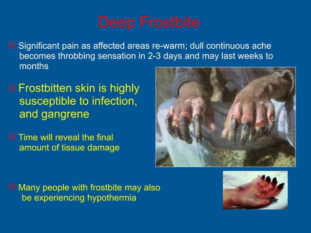 Cold Related Injuries. Hypothermia, Frostbite & Trench foot | PPT ...