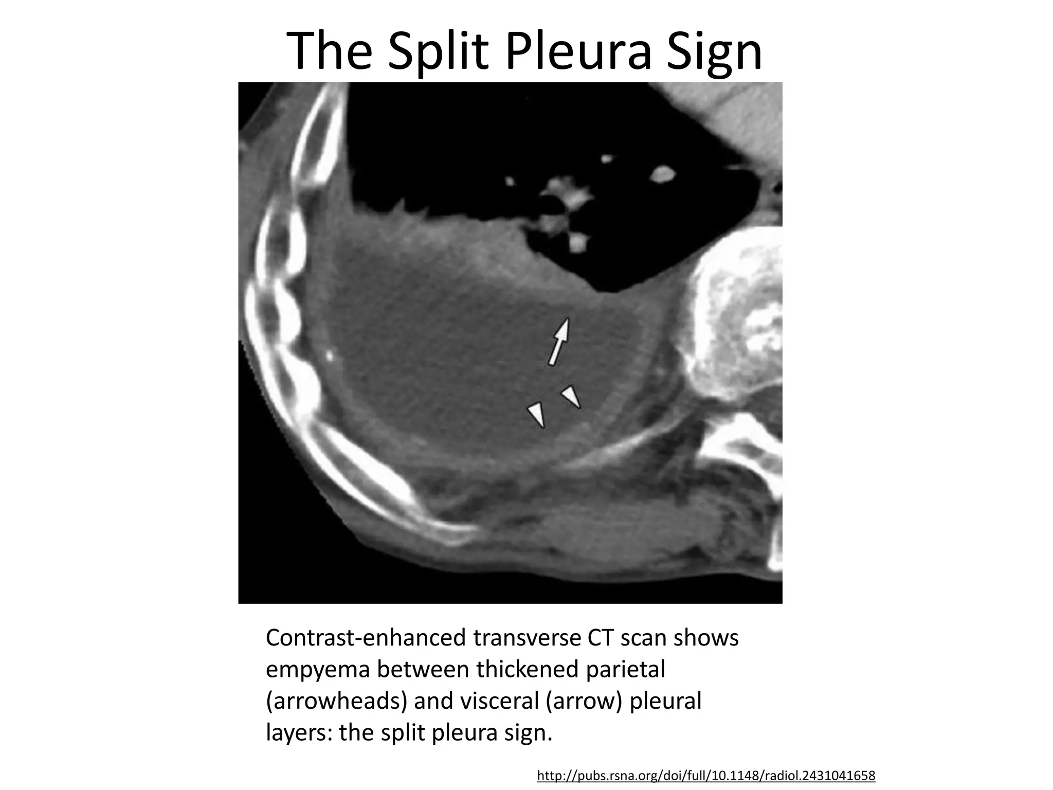 Pleural Emphysema | PPTX