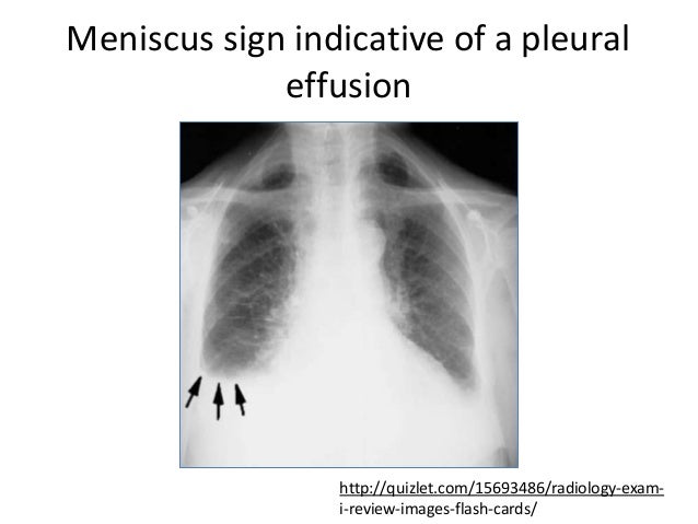 Pleural Emphysema