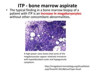 Idiopathic Thrombocytopenic Purpura Bone Marrow Findings