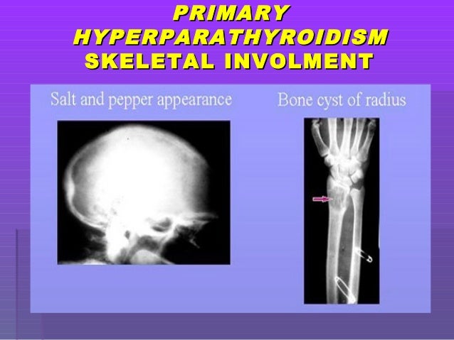 Primary Hyperparathyroidism Radiology