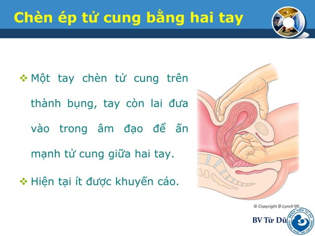 BĂNG HUYẾT SAU SINH | PDF