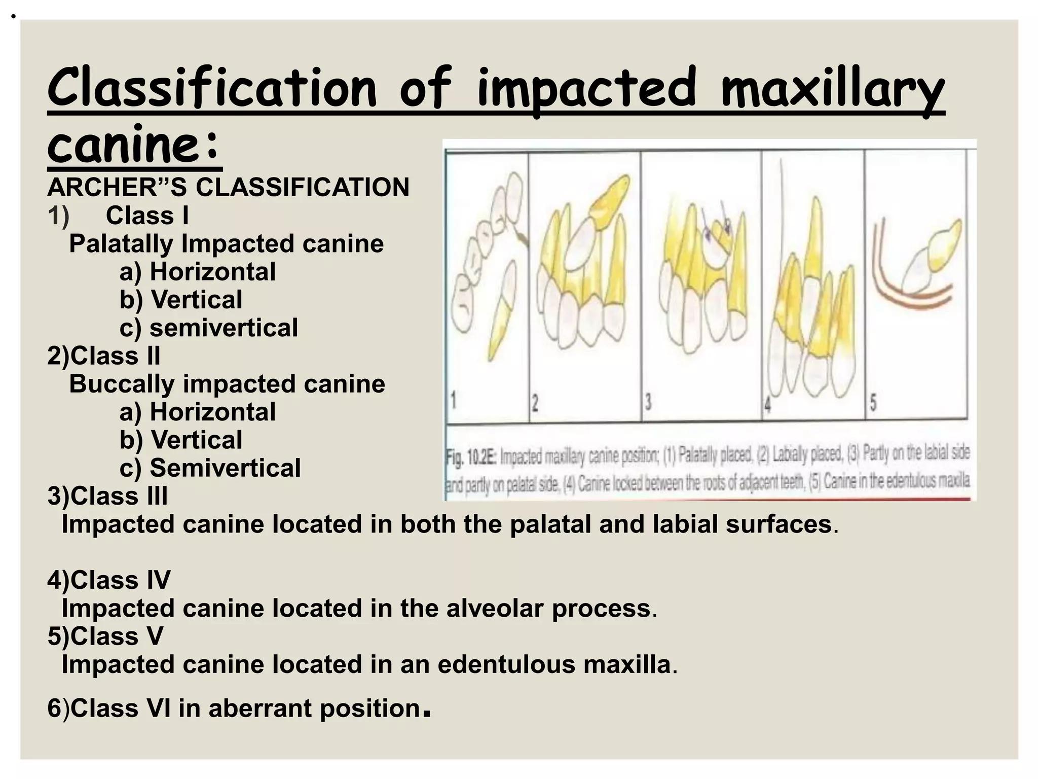 orthodontic management of impacted canine. | PPTX