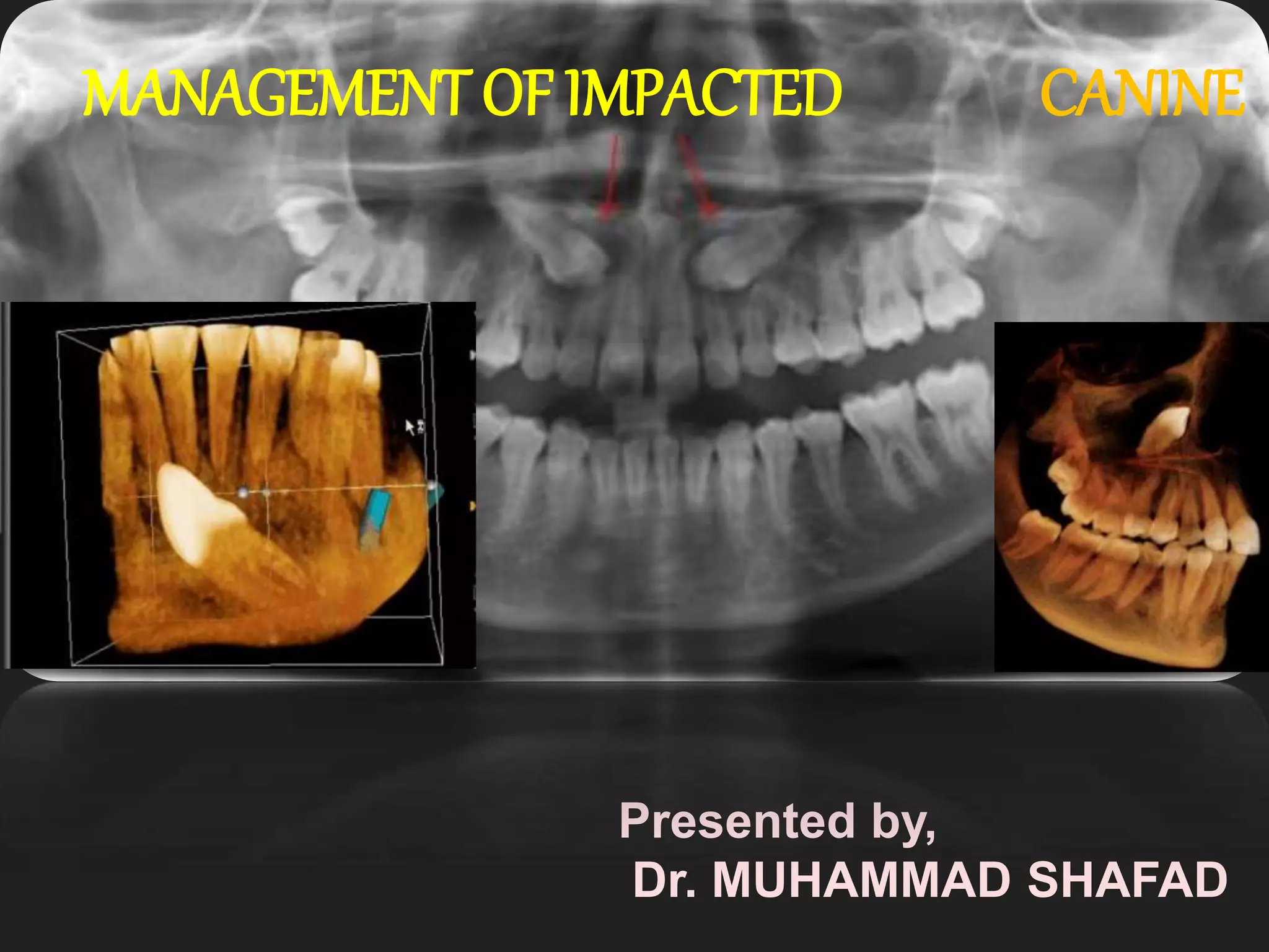 orthodontic management of impacted canine. | PPTX